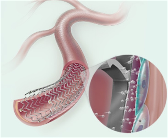 Il nuovo stent Zilver PTX a eluizione di farmaco prodotto da Cook ...