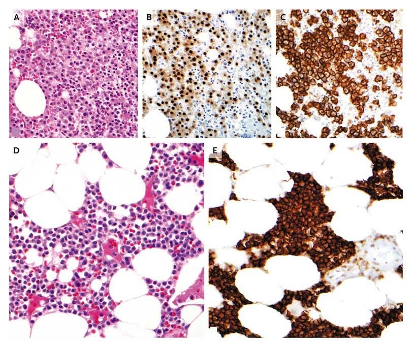 Mieloma multiplo: uno studio apre nuove prospettive per prognosi e ...