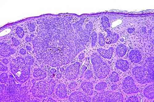 Basalioma: il tumore di chi sta all'aria aperta