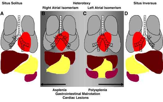 Asplenia congenita isolata: scoperta mutazione genica dietro la ...