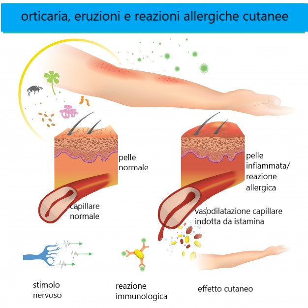Orticaria cronica spontanea: tre webinar per fare il punto e proporre ...